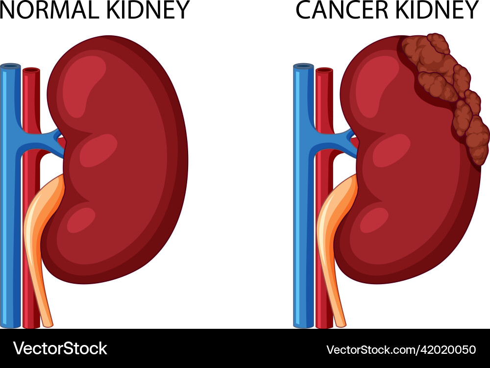 Normal kidney and cancer Royalty Free Vector Image