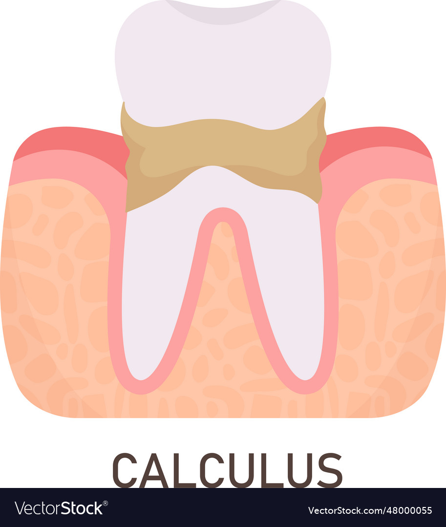 Calculus tooth problem Royalty Free Vector Image