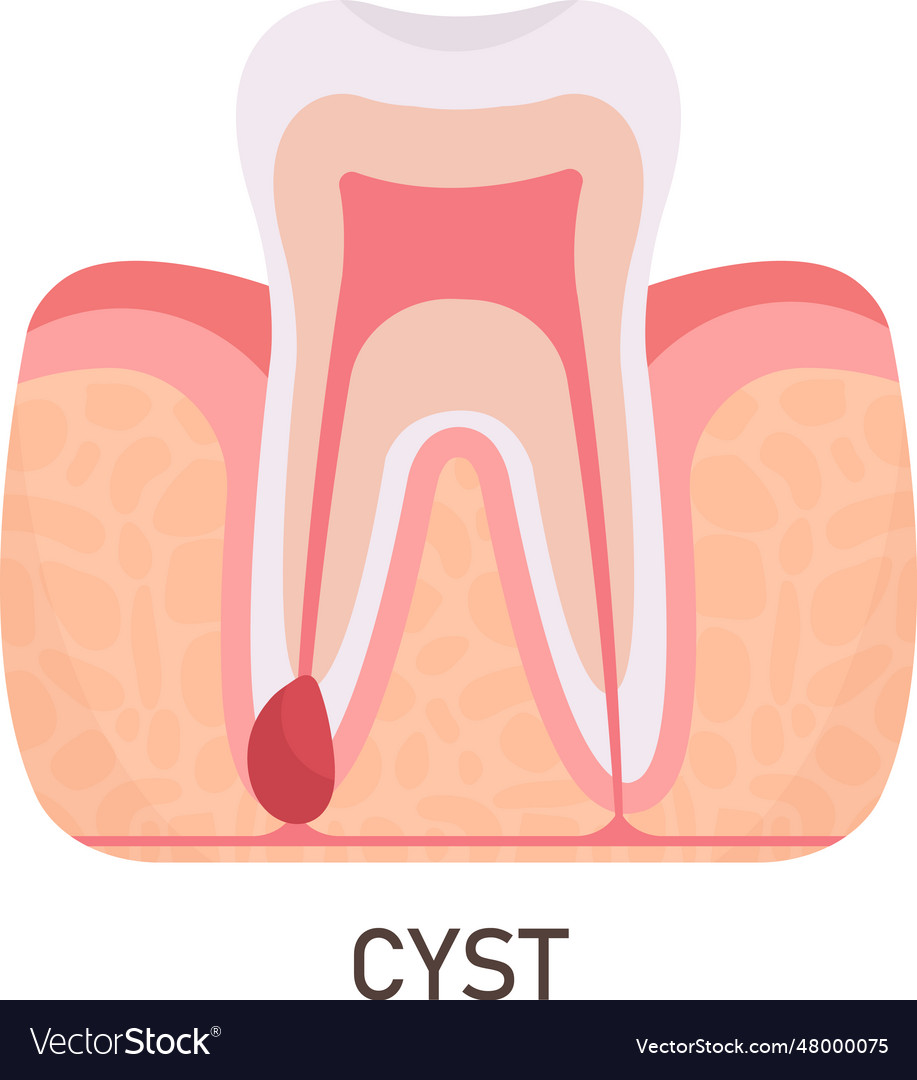 Cyst tooth problem Royalty Free Vector Image - VectorStock