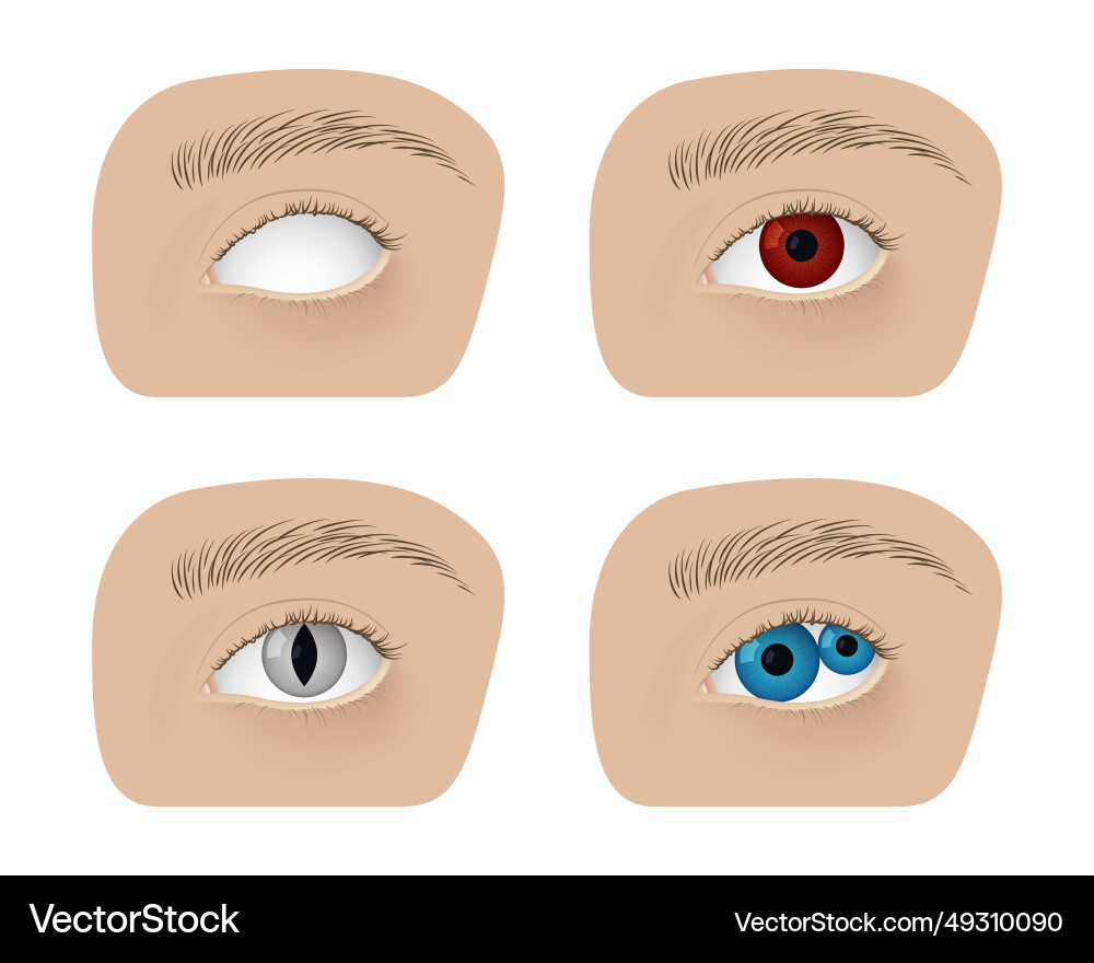 Realistic human healthy eye and with cataract Vector Image