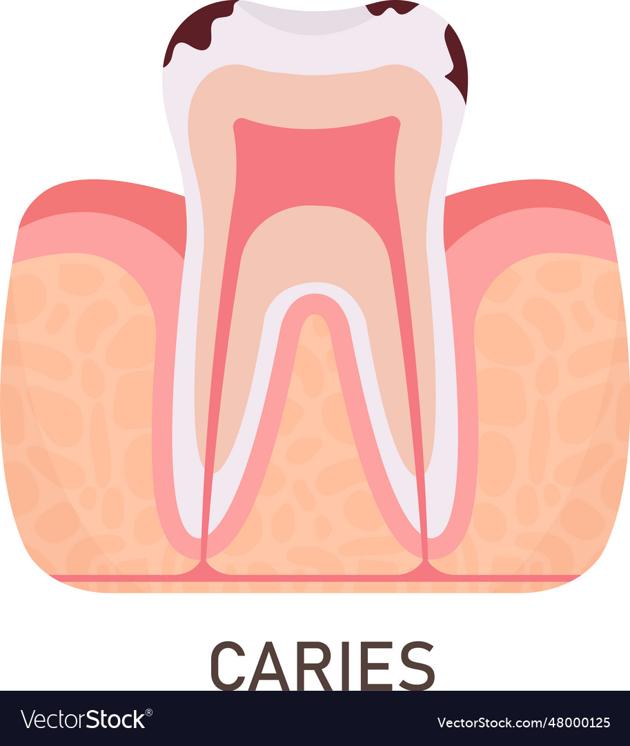Caries tooth problem Royalty Free Vector Image
