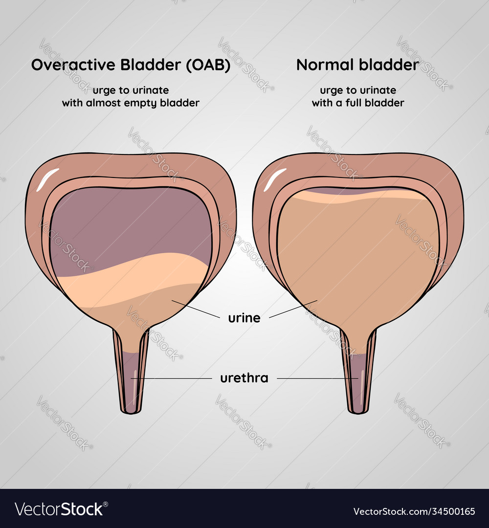 Overactive and normal bladder urinary system Vector Image