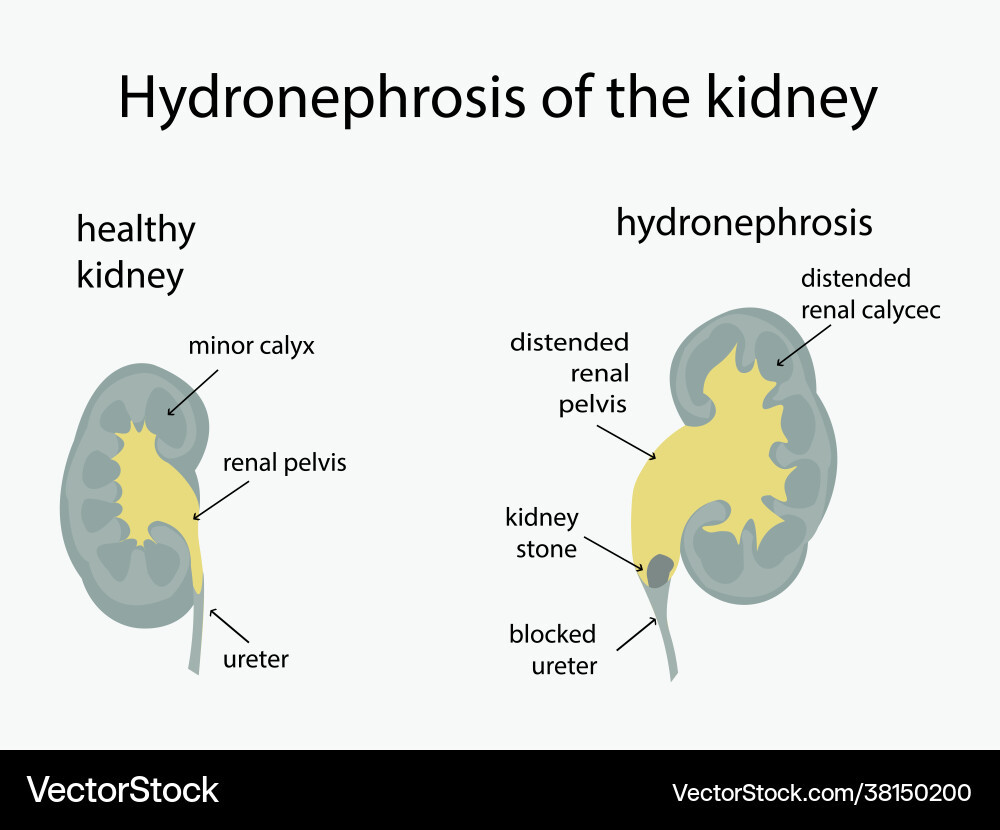 Hydronephrosis and healthy kidneys urology Vector Image