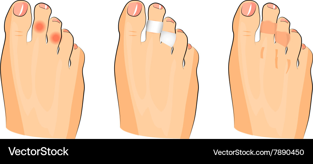 Corns on the toes Royalty Free Vector Image - VectorStock