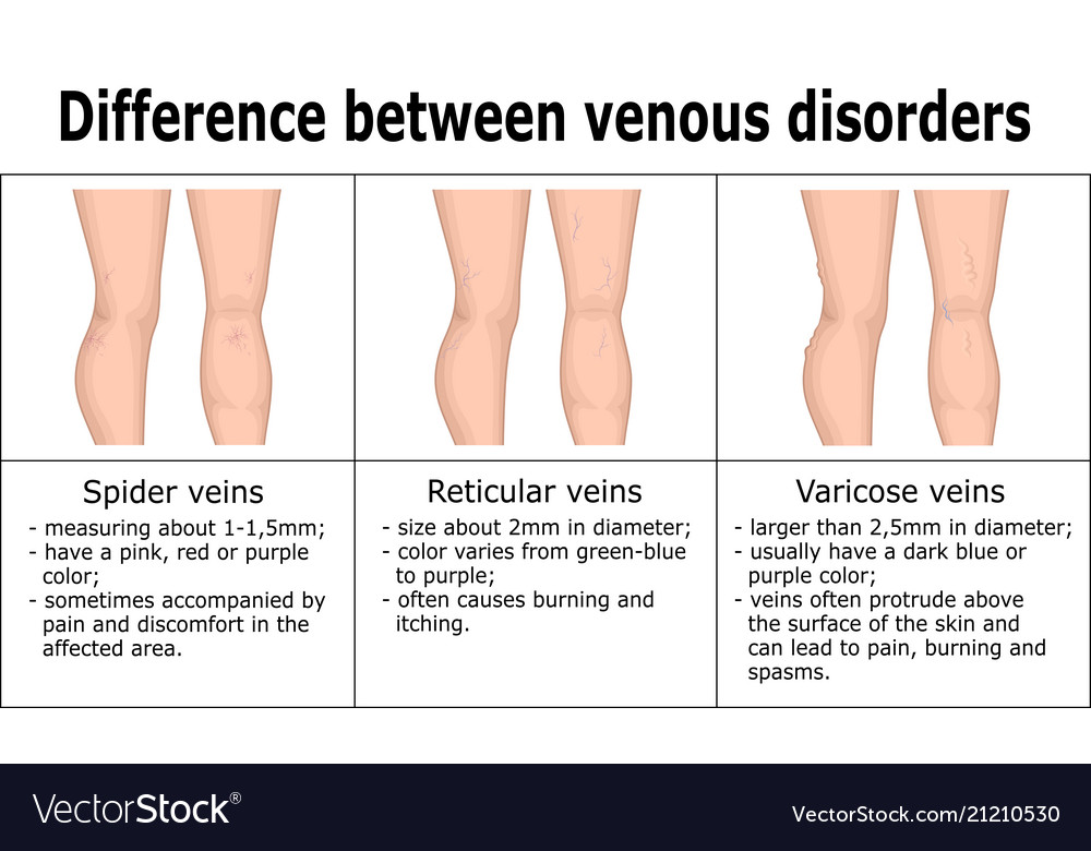 Difference between venous disorders Royalty Free Vector