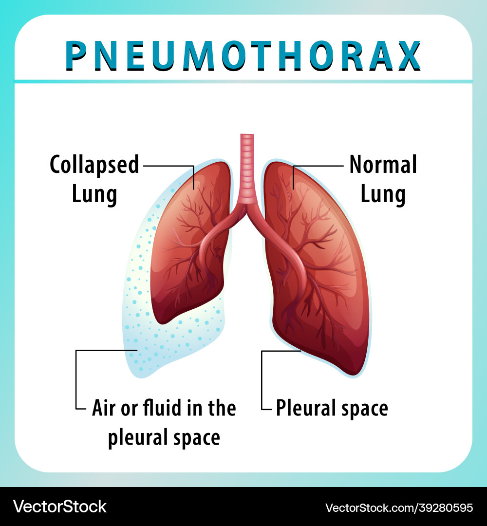 Pneumothorax diagram with collapsed lung Vector Image