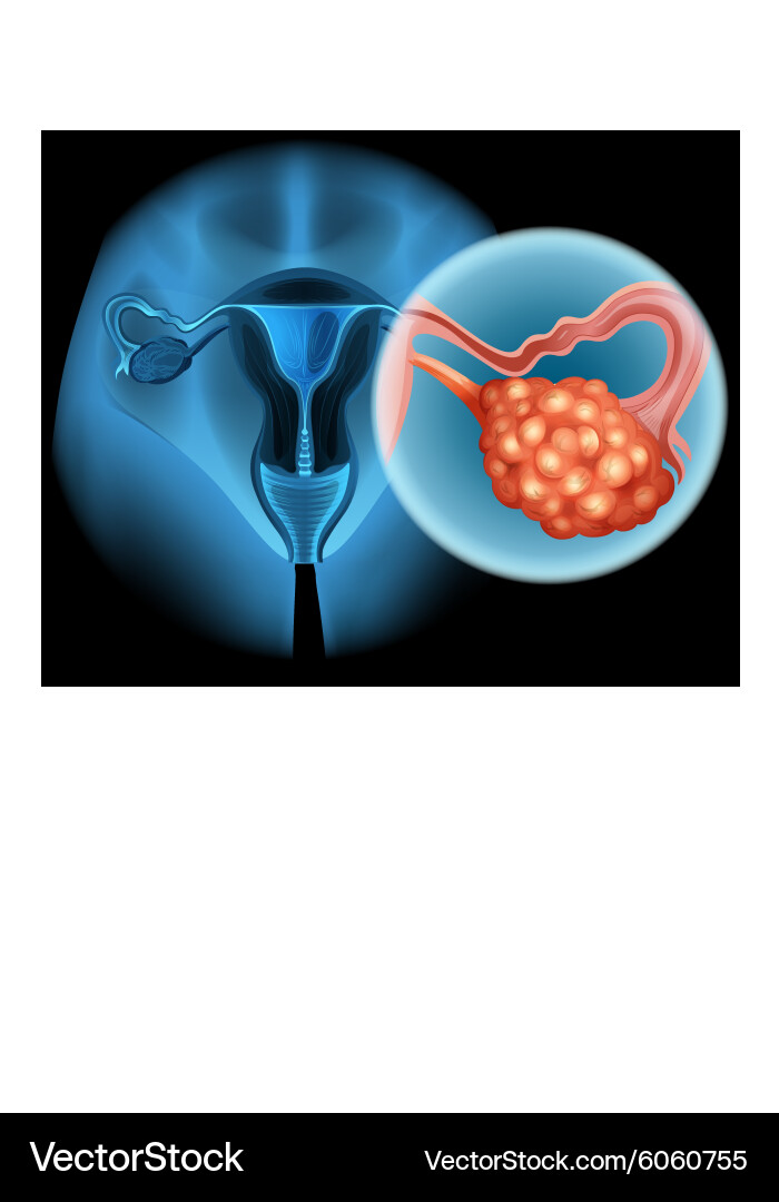 Ovarian cancer in human Royalty Free Vector Image