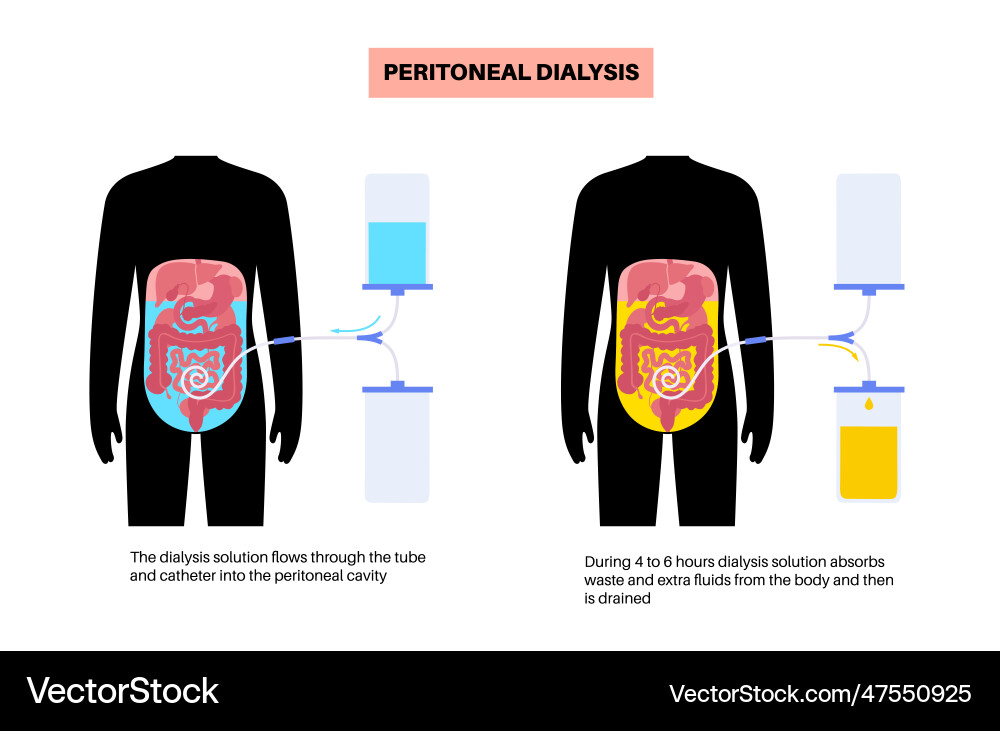 Peritoneal dialysis concept Royalty Free Vector Image