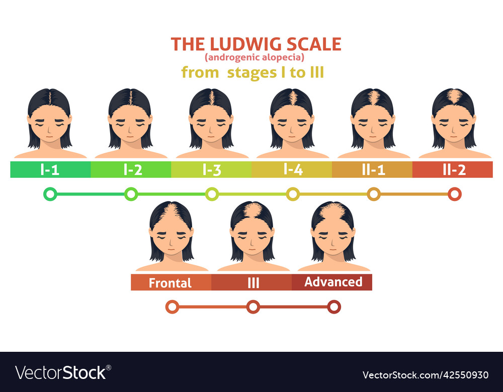 Ludwig Scale Of Androgenic Alopecia Step Poster Vector Image