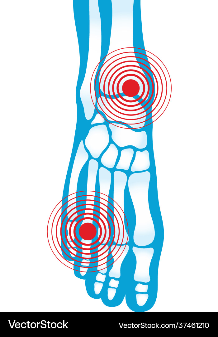 Foot rheumatological pain Royalty Free Vector Image