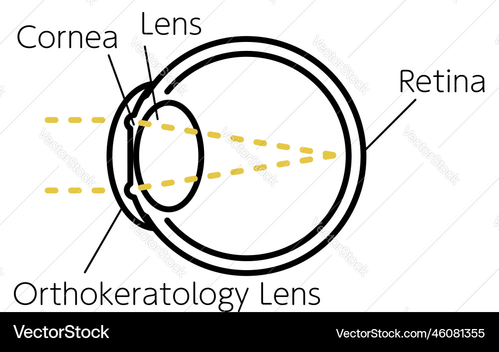 Orthokeratology and vision correction lenses Vector Image