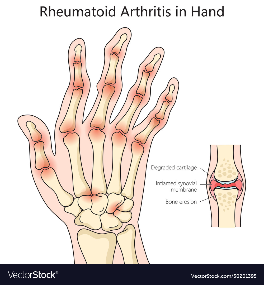 Rheumatoid arthritis diagram medical science Vector Image