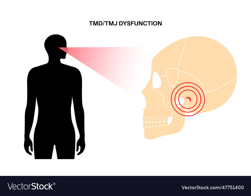 Tmd Tmj Disorder Royalty Free Vector Image Vectorstock