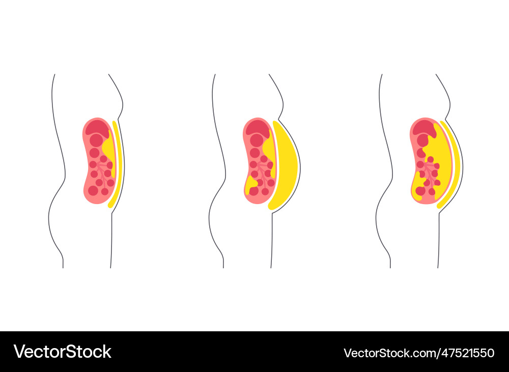 Visceral fat diagram Royalty Free Vector Image
