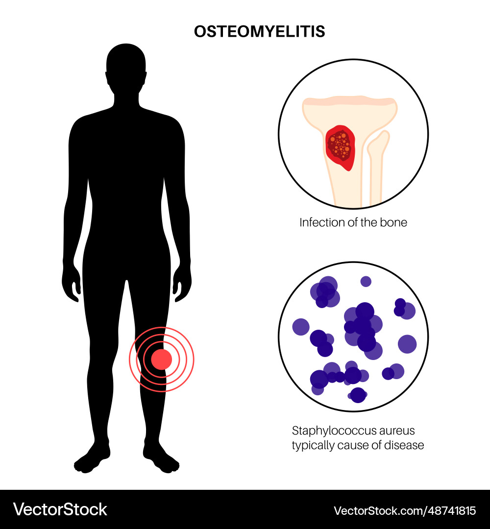 Tibia bone osteomyelitis Royalty Free Vector Image