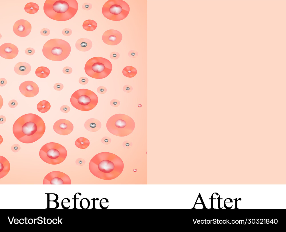 Texture inflamed pimples and acne before after Vector Image