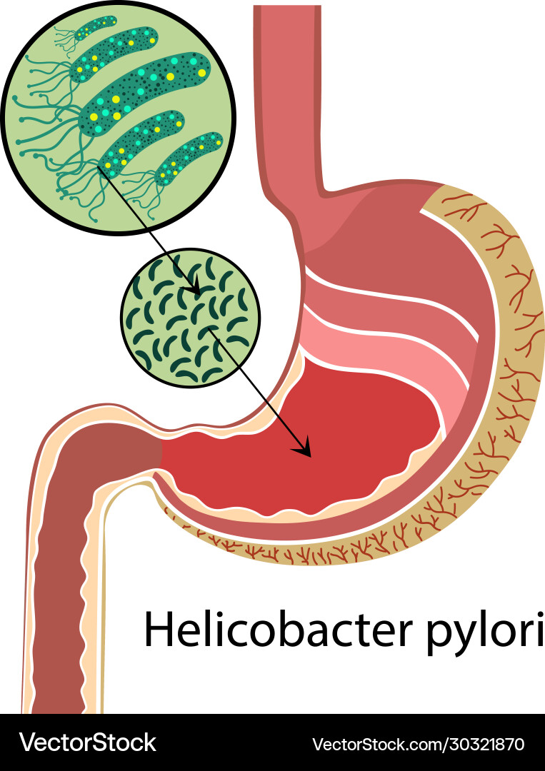 Stomach and helicobacter pylori Royalty Free Vector Image