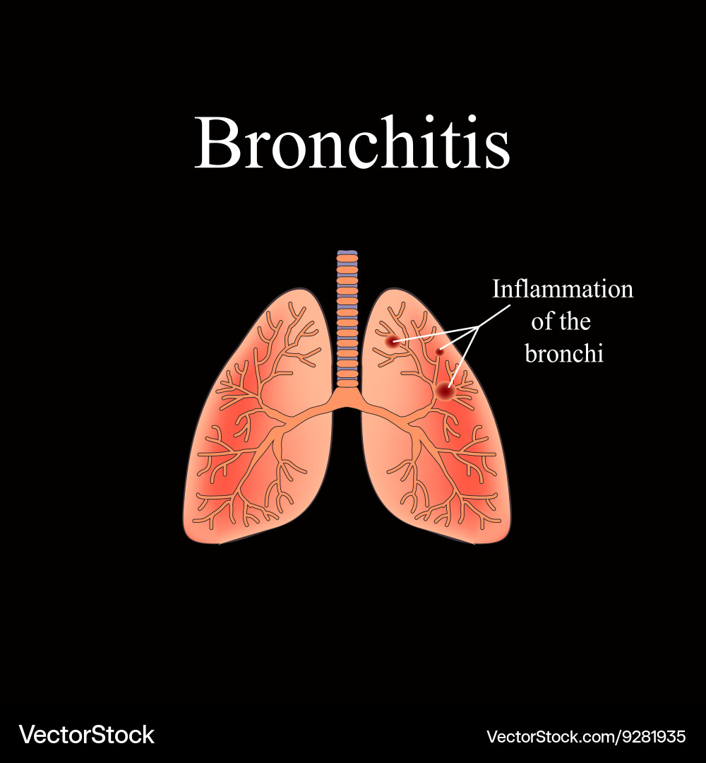 Bronchitis the anatomical structure of human Vector Image