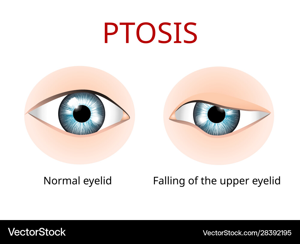 Ptosis eyelid eye sickness anatomy Royalty Free Vector Image