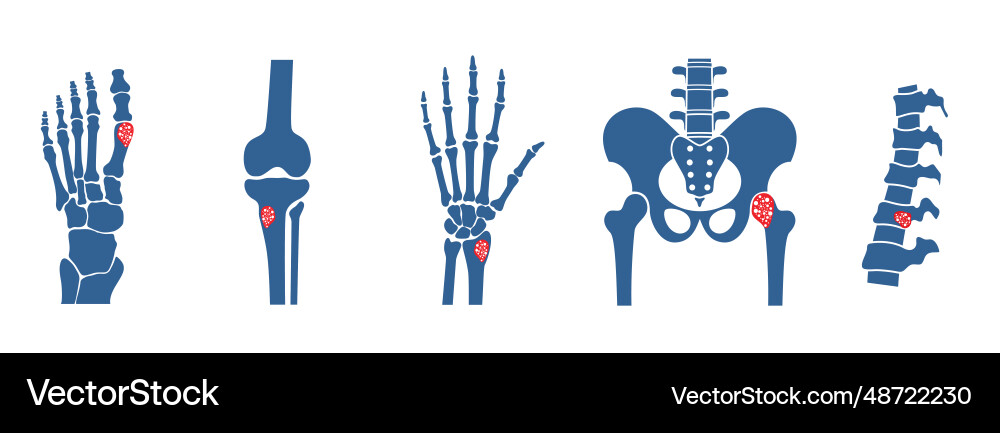 Osteomyelitis disease poster Royalty Free Vector Image