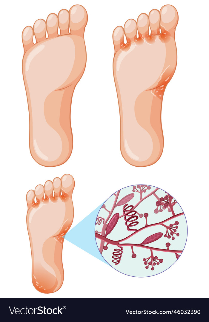 Trichophyton Rubrum Fungal Infection Royalty Free Vector