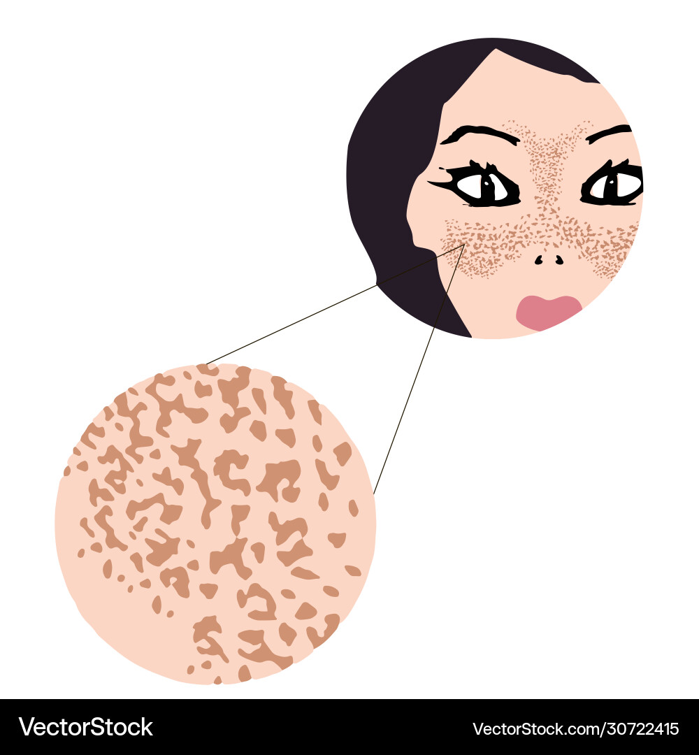 Freckles on face pigmentation on skin Royalty Free Vector
