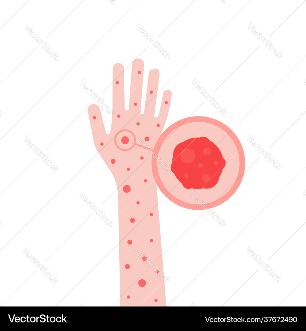 Cartoon hand with psoriasis or eczema Royalty Free Vector
