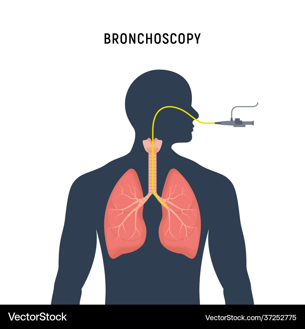 Bronchoscopy respiratory system emphysema Vector Image