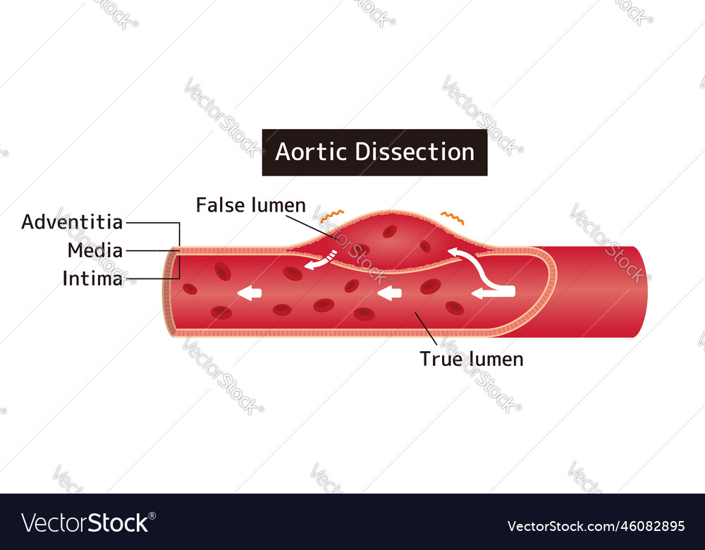 Aortic dissection Royalty Free Vector Image - VectorStock