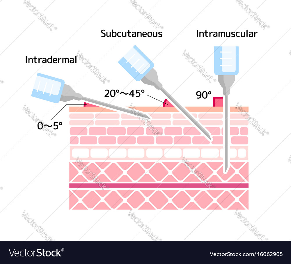 Angles for inserting injections Royalty Free Vector Image