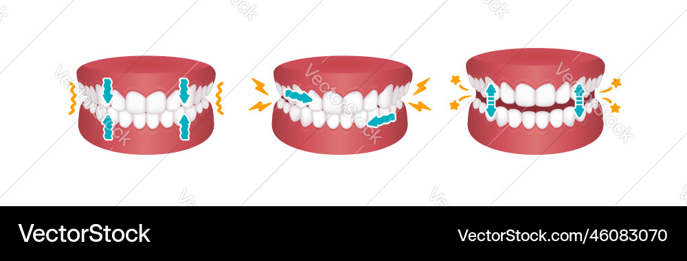 Types of bruxism teeth grinding Royalty Free Vector Image
