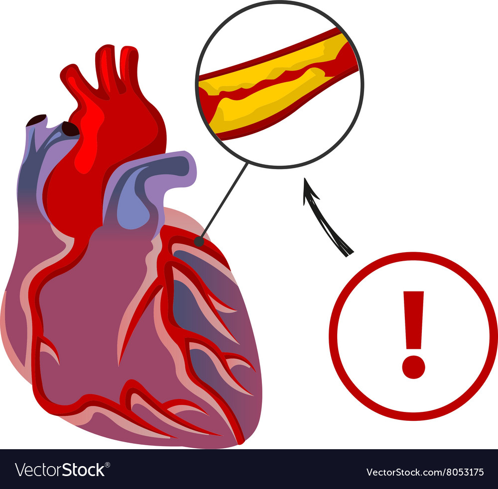 The risk heart failure Royalty Free Vector Image The risk heart failure Royalty Free Vector Image