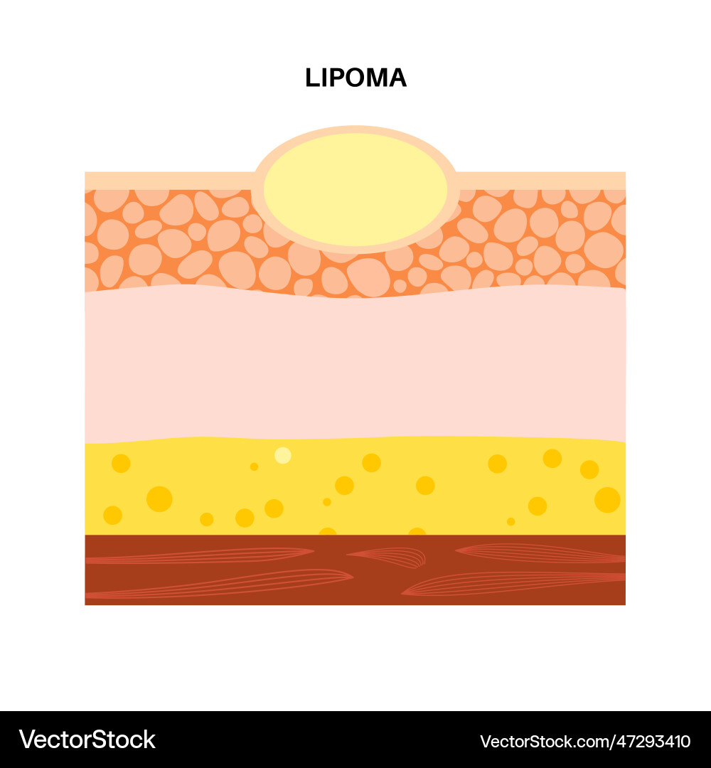Lipoma medical poster Royalty Free Vector Image