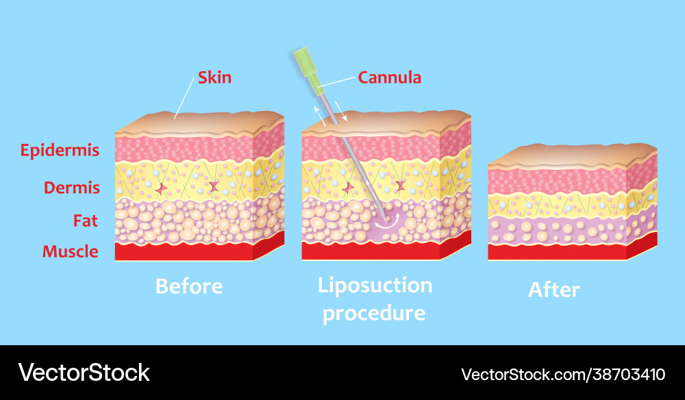 Mechanism liposuction suction-assisted Royalty Free Vector