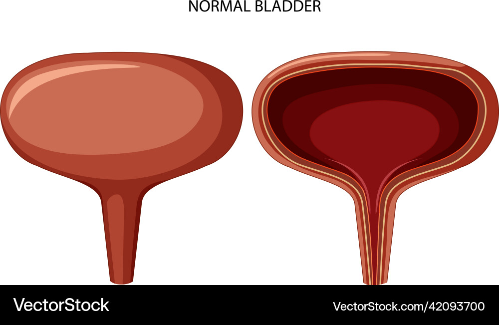 Stage of bladder cancer Royalty Free Vector Image