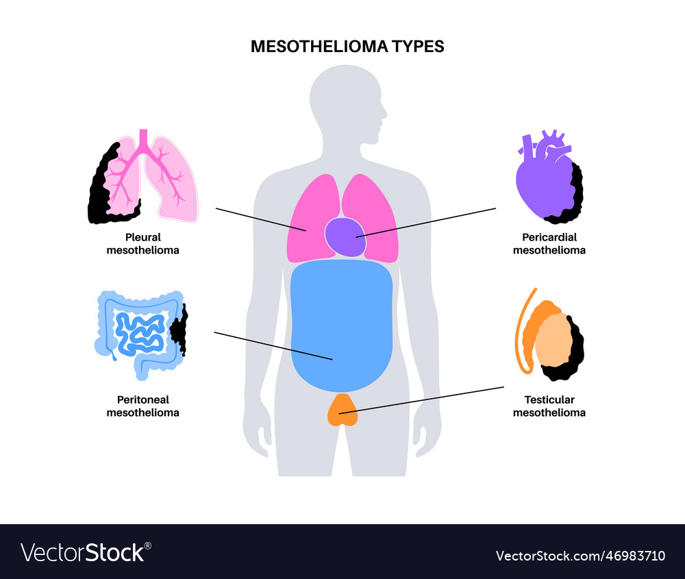 Mesothelioma tumor types Royalty Free Vector Image Mesothelioma tumor types Royalty Free Vector Image
