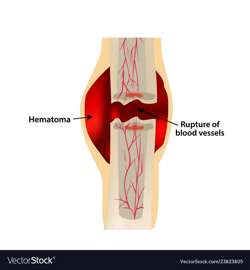 1 stage of healing bone fracture formation Vector Image