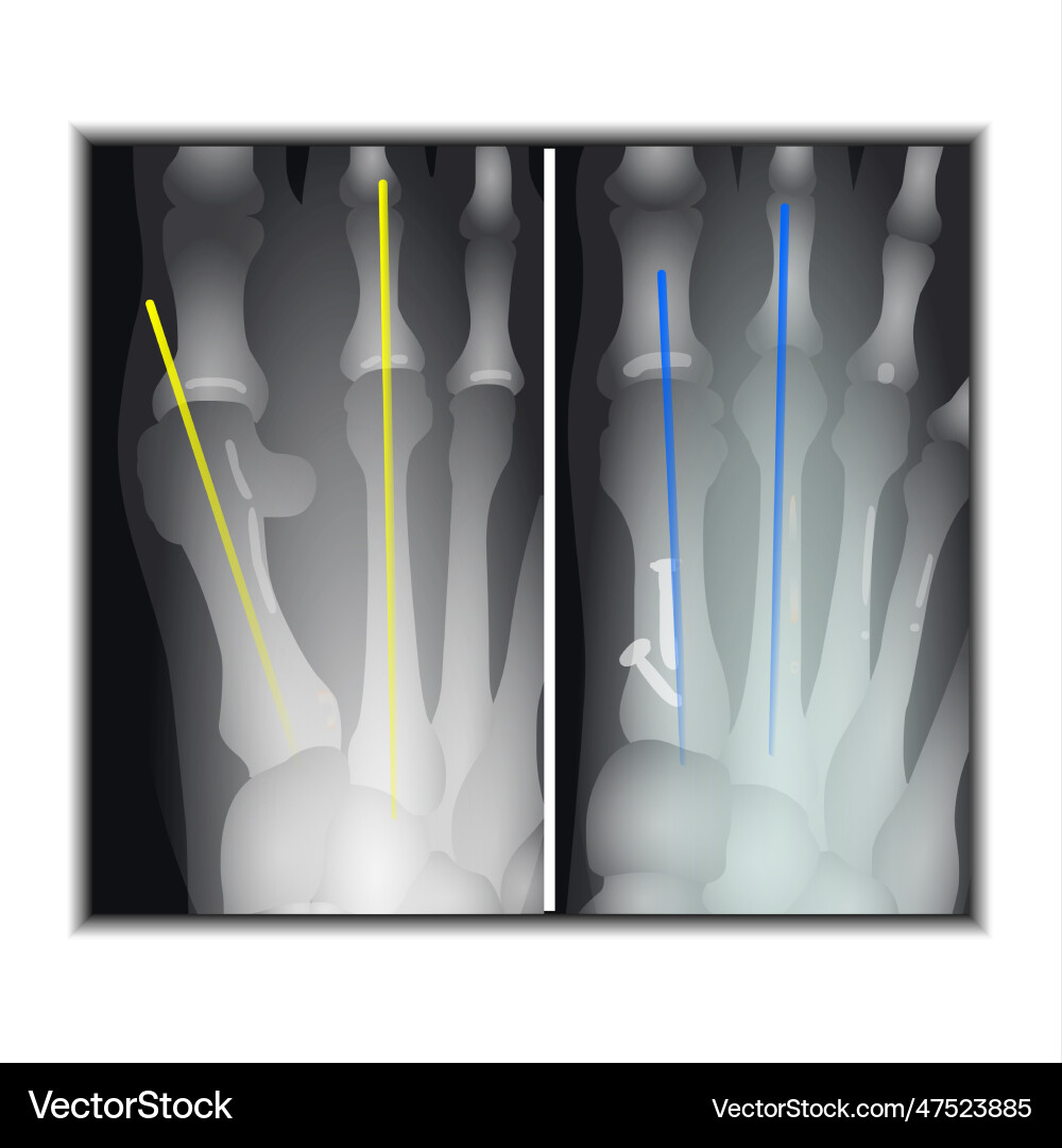 X-ray of foot claw Royalty Free Vector Image - VectorStock