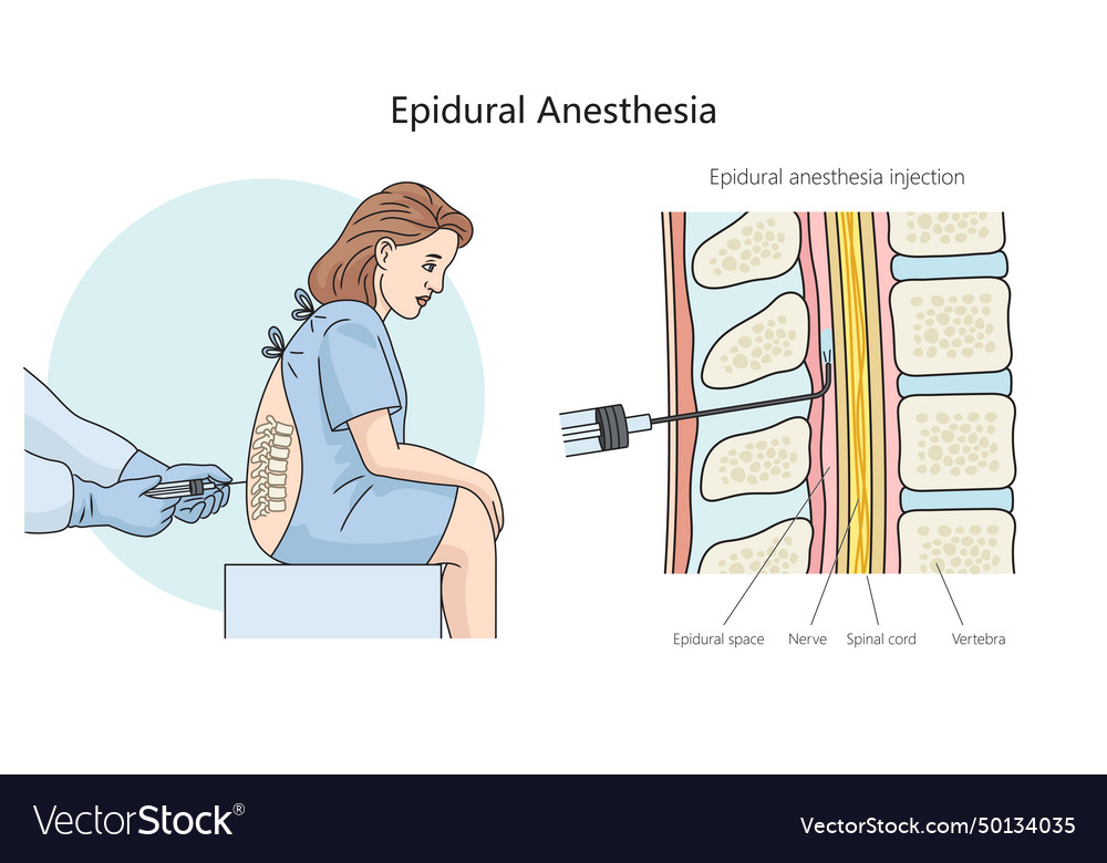 Epidural anesthesia structure diagram medical Vector Image