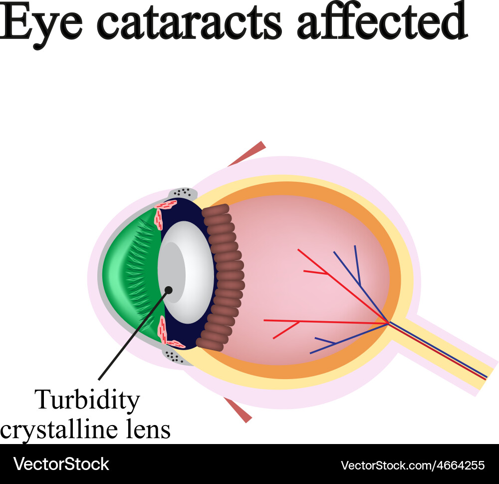 Structure of the eye eye cataracts affected Vector Image