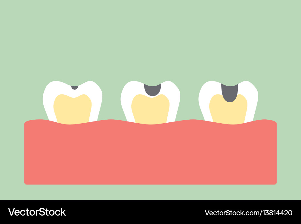 Stages of tooth decay Royalty Free Vector Image
