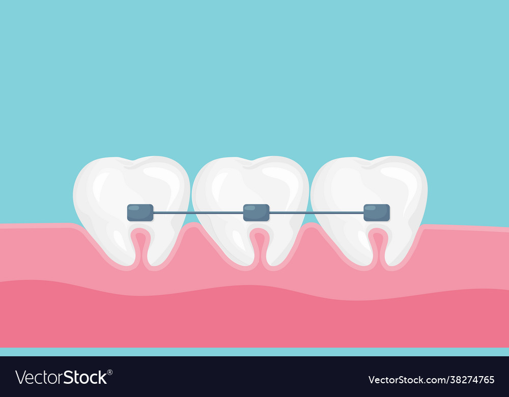 Alignment teeth bite correction help braces system
