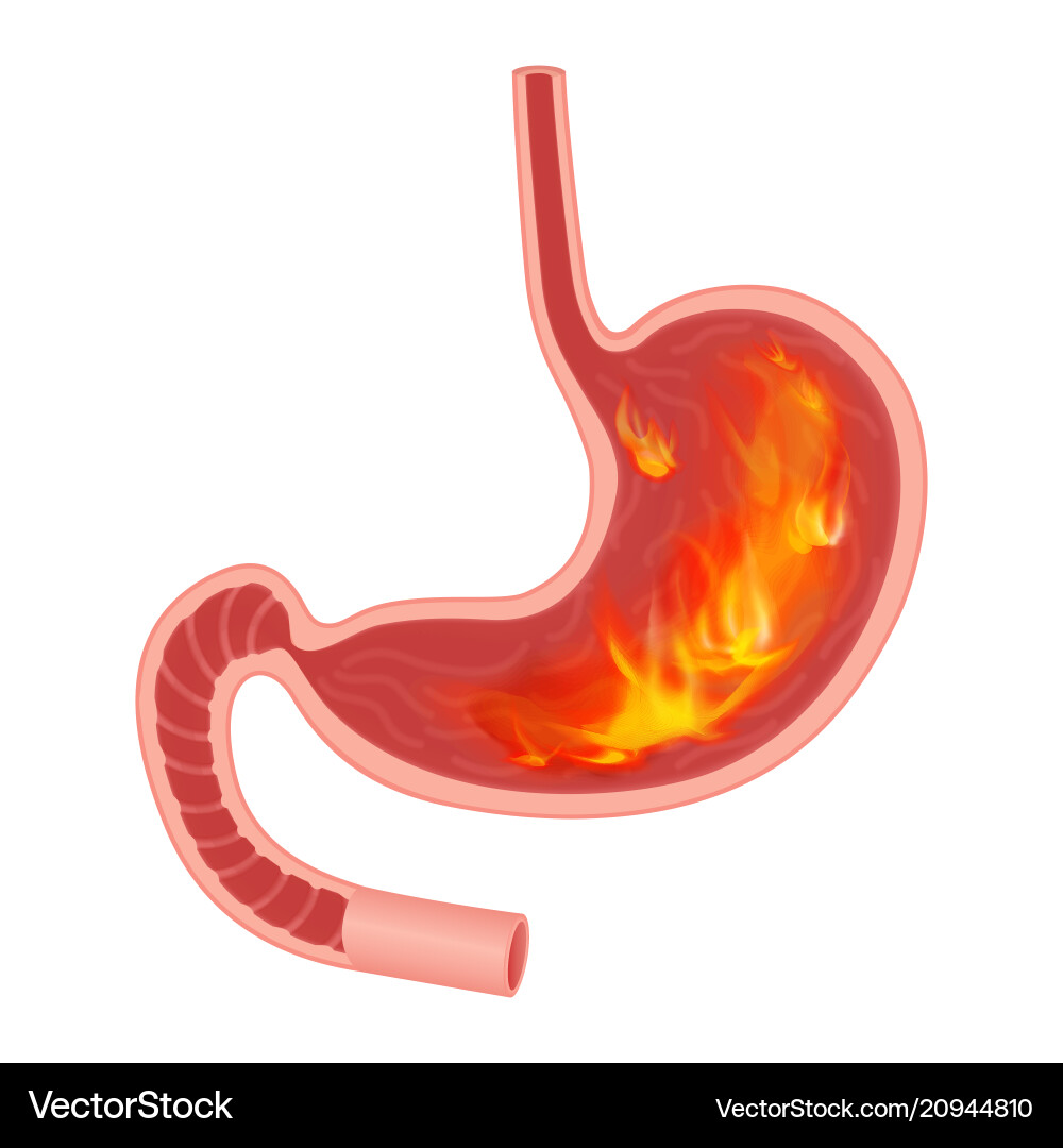 Realistic medical pyrosis stomach Royalty Free Vector Image
