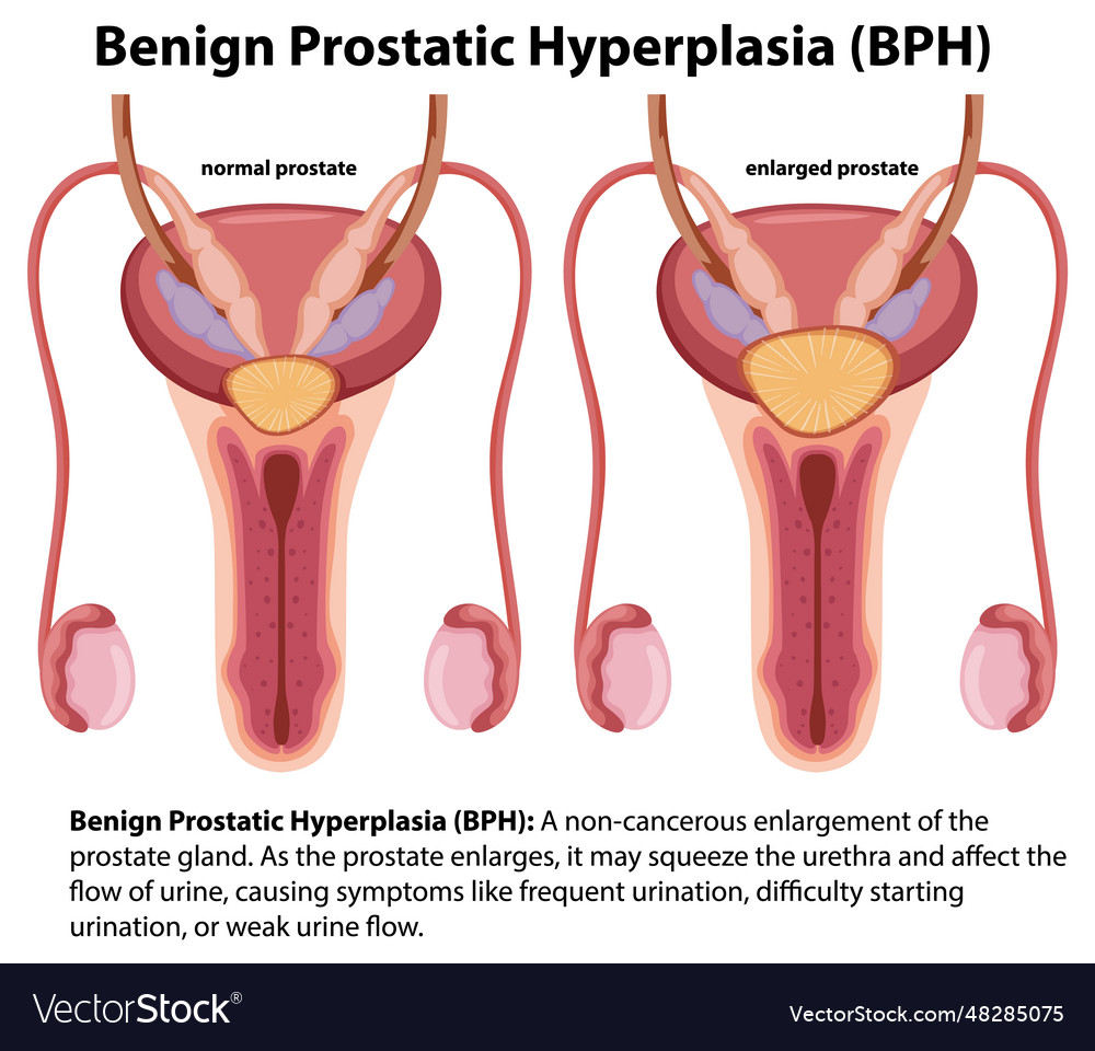 Male benign prostatic hyperplasia infographic Vector Image