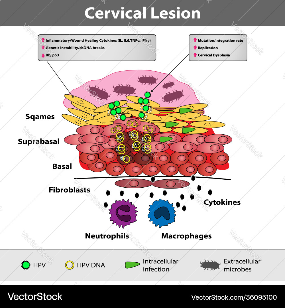 A precancerous cervical lesion abnormal cervical Vector Image