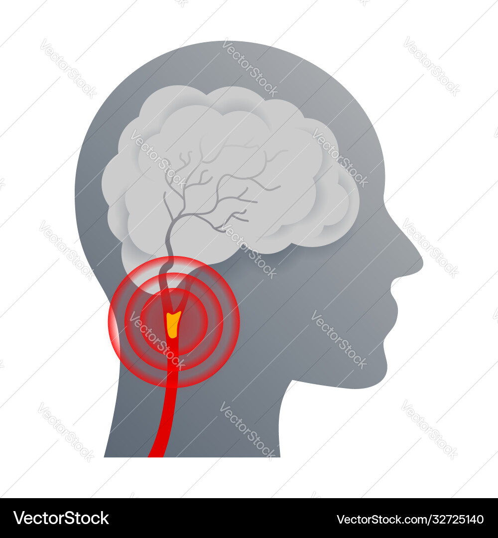 Cerebrovascular disease ischemic icon Royalty Free Vector