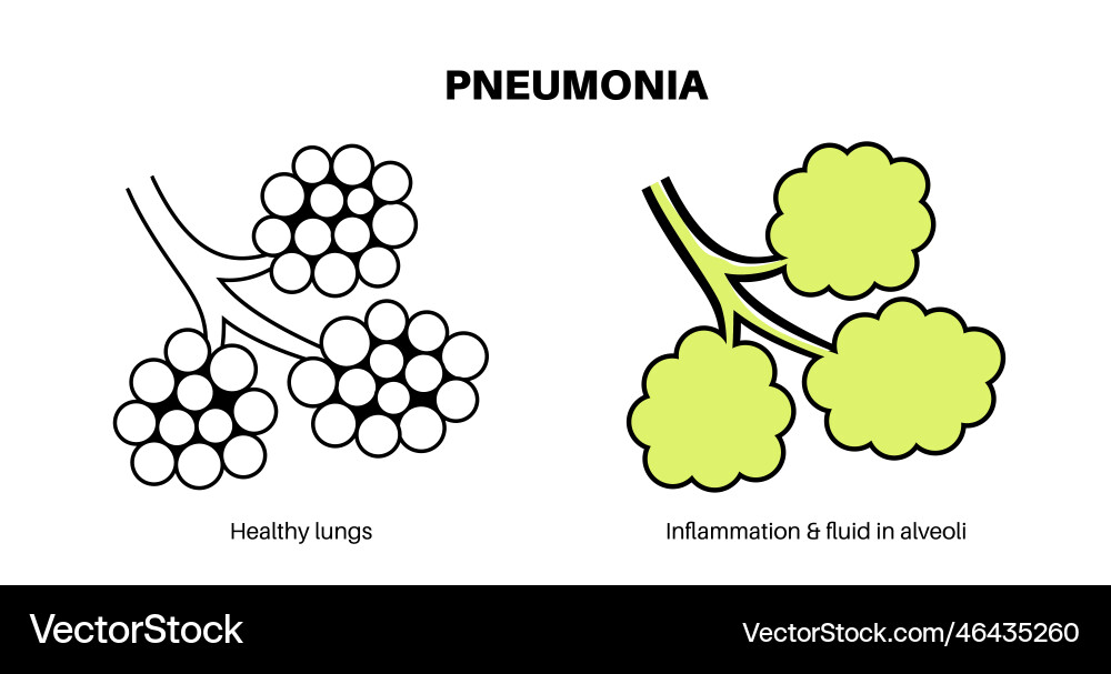 Pneumonia infection poster Royalty Free Vector Image