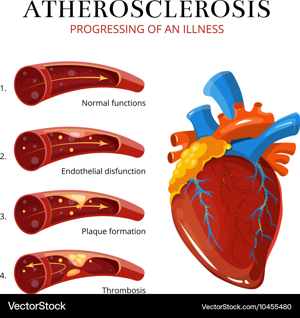 Atherosclerosis blood clot formation Royalty Free Vector