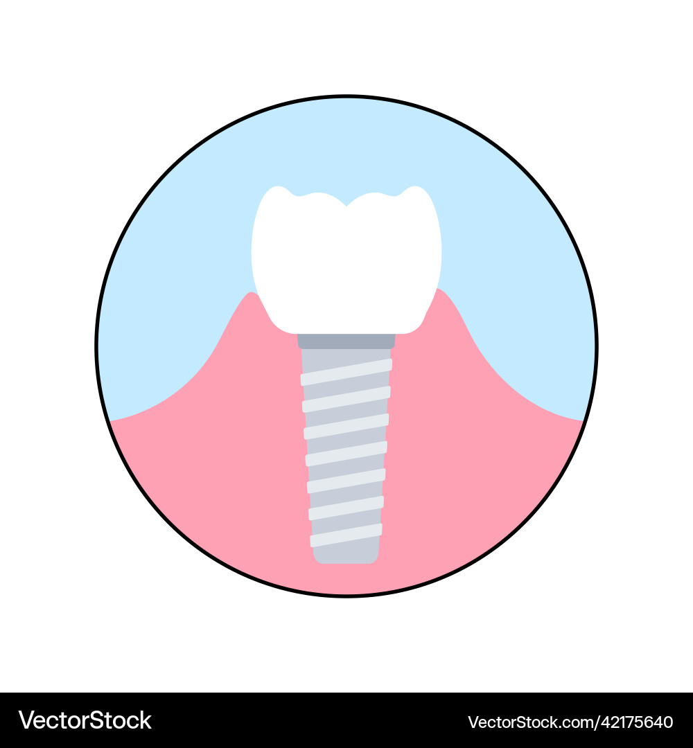 Dental implant procedure Royalty Free Vector Image