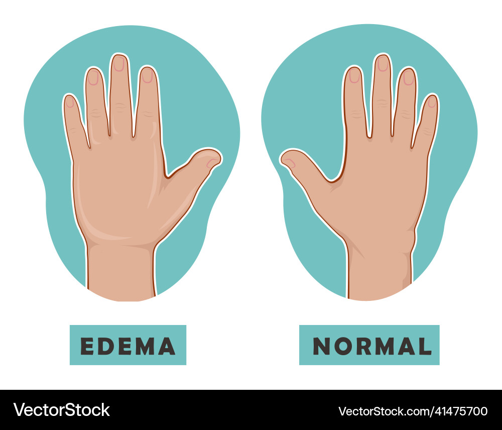 Swollen hand and normal hand edema and lymphedema Vector Image